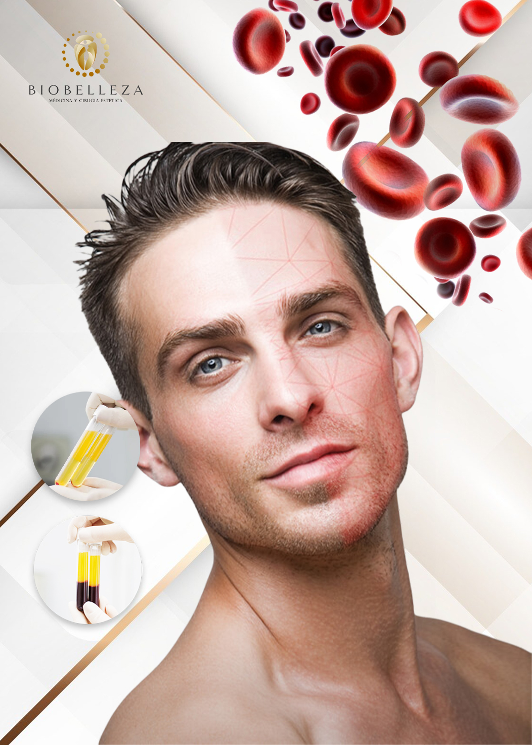 PLASMA GEL FILLER MAS PLASMA RICO | Clínica Biobelleza - Medicina y ...